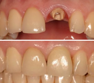 Single Tooth dental implant - NC Prosthodontic Specialists